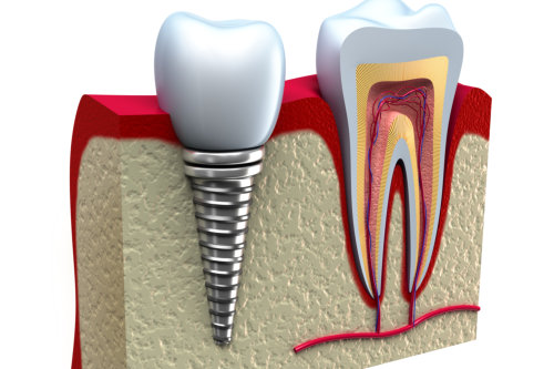 implants - Woodbridge Smiles implants - Woodbridge Smiles
